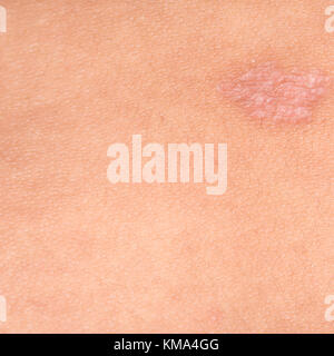 Le psoriasis Le psoriasis de la peau. est une maladie auto-immune qui ...