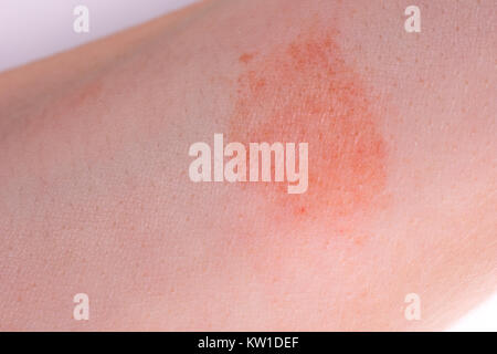 Tache rouge sur la peau Photo Stock - Alamy