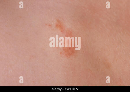 Tache rouge sur la peau Photo Stock - Alamy