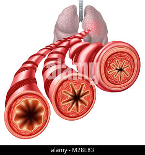 Concept de l'anatomie de la Bronchite inflammation de la muqueuse du ...