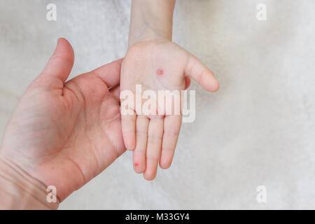 La main d'un enfant atteint de varicelle dans la main de sa mère. Des ...