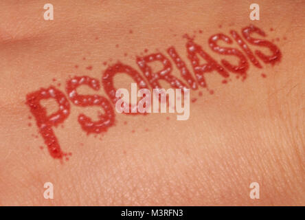 La maladie le psoriasis et les maladies auto-immunes comme des taches ...