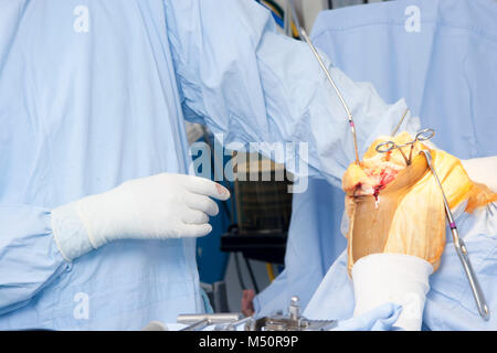 Détail de la chirurgie orthopédique, opération, chirurgie du genou ...