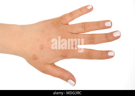 L'eczéma dermatite sur la peau du bras de la femme, isolé sur fond ...