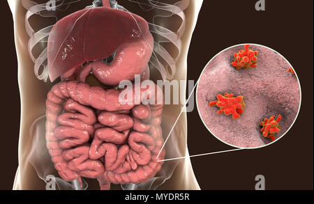 Amibe parasitaire (Entamoeba histolytica) dans le gros intestin, l ...