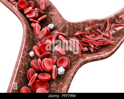 La drépanocytose. Illustration montrant les cellules de sang blanches ...