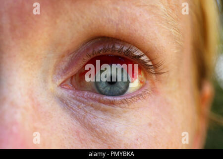 Oeil de womans de tessons de vaisseau sanguin (hémorragie sous ...