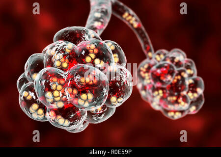 La pneumonie à pneumocoques. Illustration d'ordinateur de Streptococcus ...