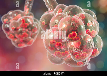 La pneumonie à pneumocoques. Illustration d'ordinateur de Streptococcus ...