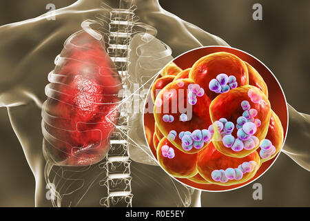La pneumonie à pneumocoques. Illustration d'ordinateur de Streptococcus ...