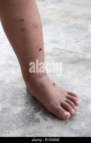 La dermatite prurigineuse bébé atopique pied. Close up.plaies infectées ...