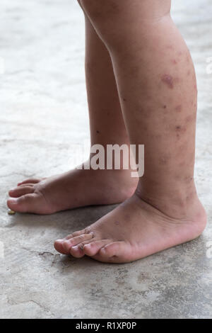 La dermatite prurigineuse bébé atopique pied. Close up.plaies infectées ...