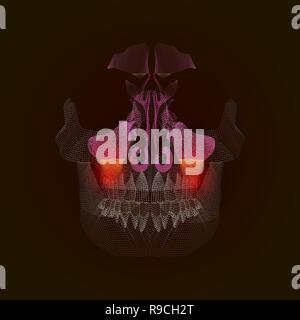 La sinusite odontogène. L'inflammation de la sinus maxillaire due à une ...