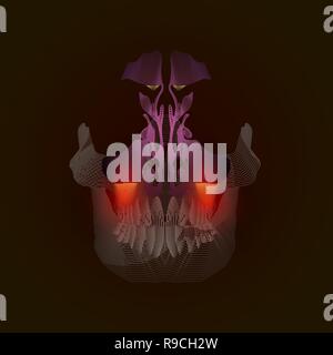 La sinusite odontogène. L'inflammation de la sinus maxillaire due à une ...