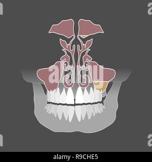 La sinusite odontogène. L'inflammation de la sinus maxillaire due à une ...
