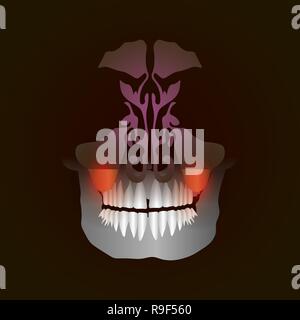 La sinusite odontogène. L'inflammation de la sinus maxillaire due à une ...