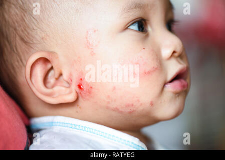 Allergie bébé éruption sur le visage / maladie baby girl face à la peau ...