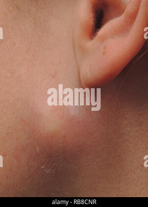 Kyste sébacé infecté. Close-up d'un grand Kyste sébacé infecté sur le ...