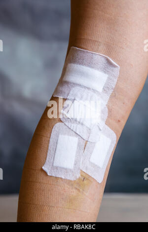 Traitement des varices par radiofréquence, l'hôpital de Dijon, France ...