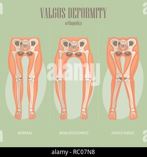 Varus valgus et normal Image Vectorielle Stock - Alamy