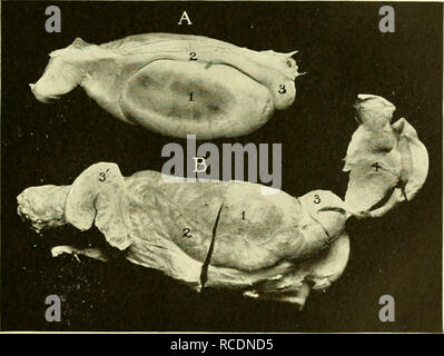 . Fig. 125-chronique abcès de l'épididyme chez les jeunes- Bull. W ...