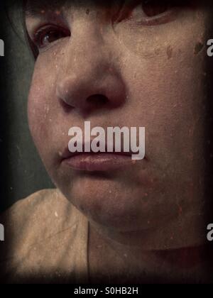 La misère : un gonflement du visage à partir d'un abcès dentaire (4 ...