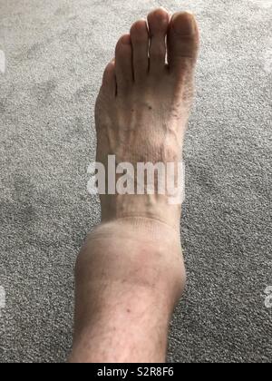 La cheville enflée de femme Photo Stock - Alamy