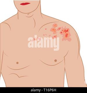 Le zona, herpès zoster, cloques sur le corps, le virus varicelle-zona ...