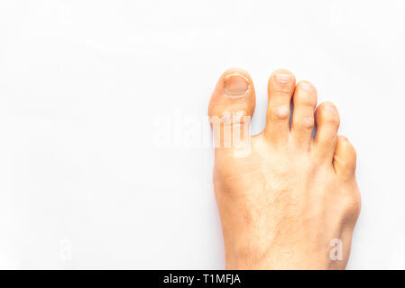 PSORIASIS SUR PIED Photo Stock - Alamy