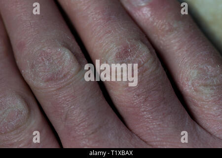 Close up of knuckles avec la peau sèche. La main de l'homme dans la ...