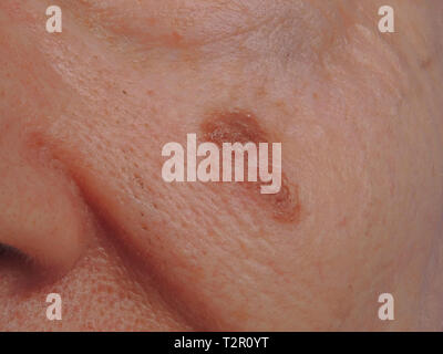 Mélanome de Dubreuilh Photo Stock - Alamy