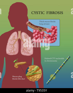 La fibrose kystique chromosome, illustration. La fibrose kystique est ...