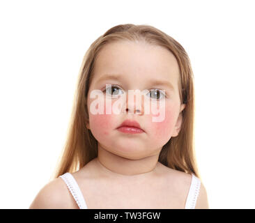 Portrait d'un enfant avec des allergies sur les joues et le menton ...