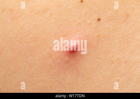 Close up photo de bouton rouge sur la peau humaine Photo Stock - Alamy