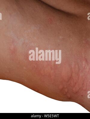 Retour d'allergie cutanés et les côtés. Réactions allergiques sur la ...