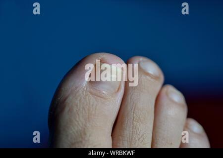 Le psoriasis de l'ongle Photo Stock - Alamy