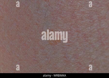 Le carcinome épidermoïde Photo Stock - Alamy