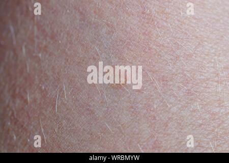 Le cancer de la peau le carcinome basocellulaire nodulaire (CCC) sur la ...