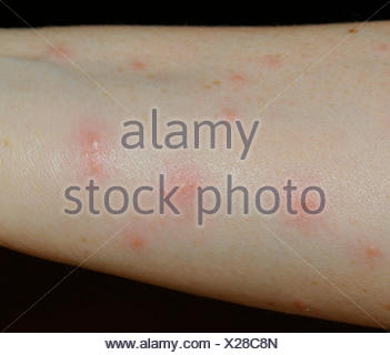 Papules et nodules sur un bras après une réaction allergique à la ...