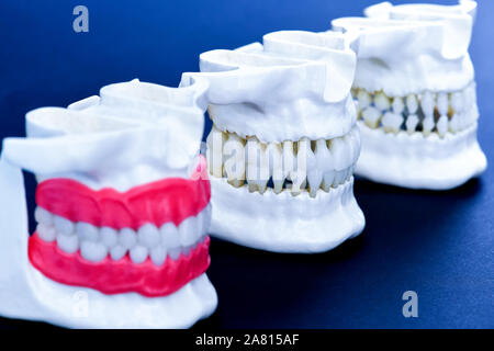 Ganasce umana con denti e gengive modelli anatomia Illustrazione medica ...