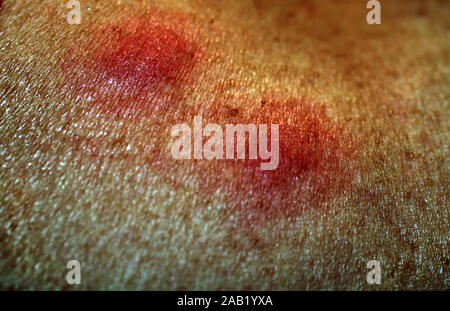 La gamba con macchia rossa causata dal morso di insetto / insetto morso ...