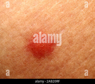 La gamba con macchia rossa causata dal morso di insetto / insetto morso ...