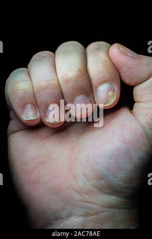 Psoriasi. La psoriasi è una malattia autoimmune che colpisce la pelle ...