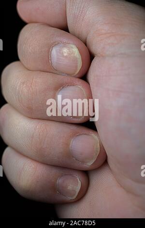 Psoriasi. La psoriasi è una malattia autoimmune che colpisce la pelle ...