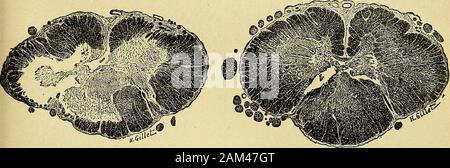 Traité des maladies de la moelle épinière . aralysie systématisée du ...