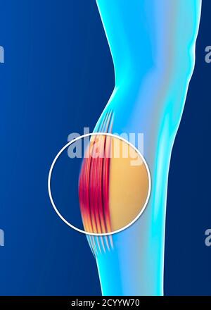 Sforzo muscolare, infiammazione dei muscoli. Polpaccio Crampi. Tendini ...