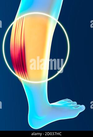 Sforzo muscolare, infiammazione dei muscoli. Polpaccio Crampi. Tendini ...
