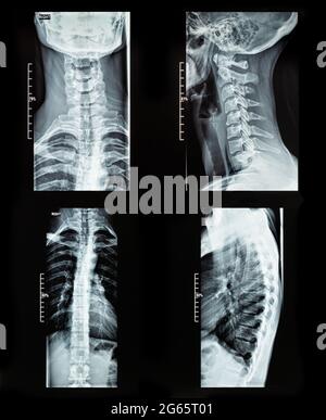 Immagini a risonanza magnetica della colonna vertebrale umana con ...