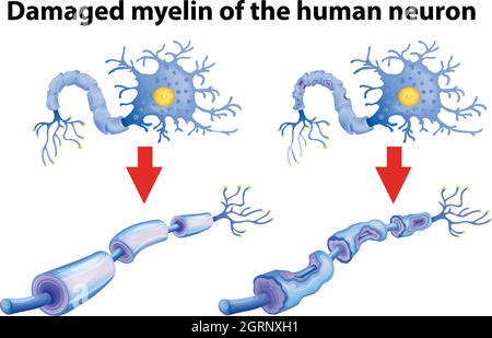 Illustrazione di cellule neuronali umane. Struttura del neurone ...