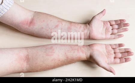 Campione di dermatite da contatto allergica - braccia maschili con ...